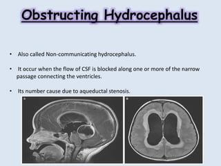 Hydrocephalus | PPTX