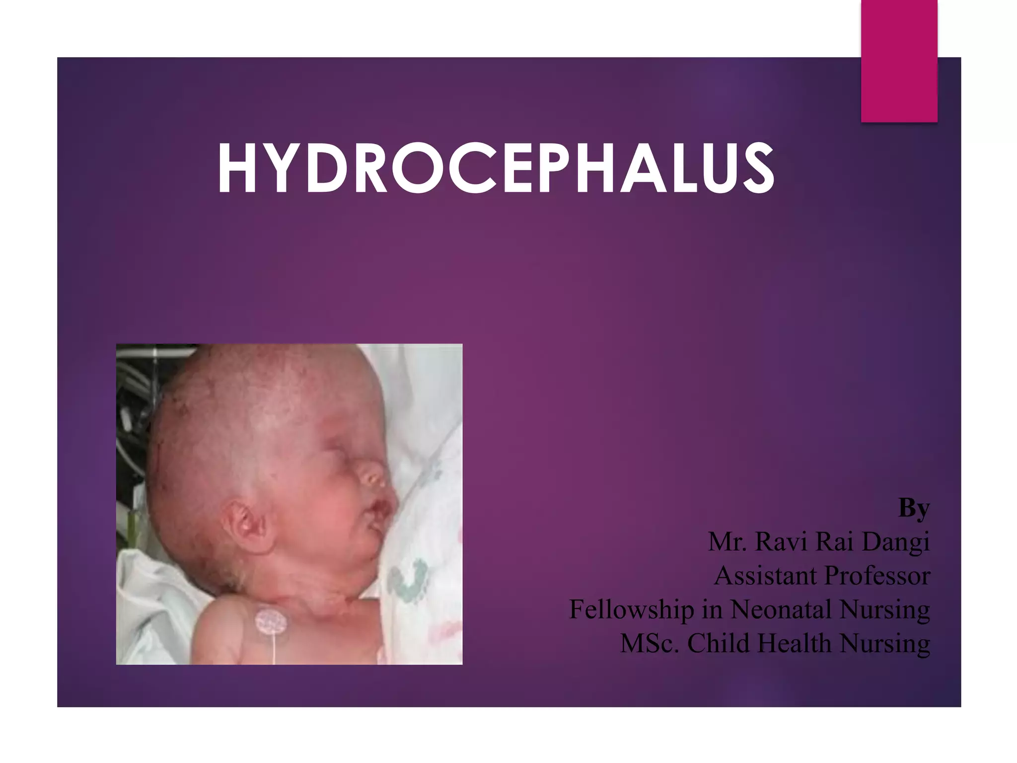 Hydrocephalus | PDF