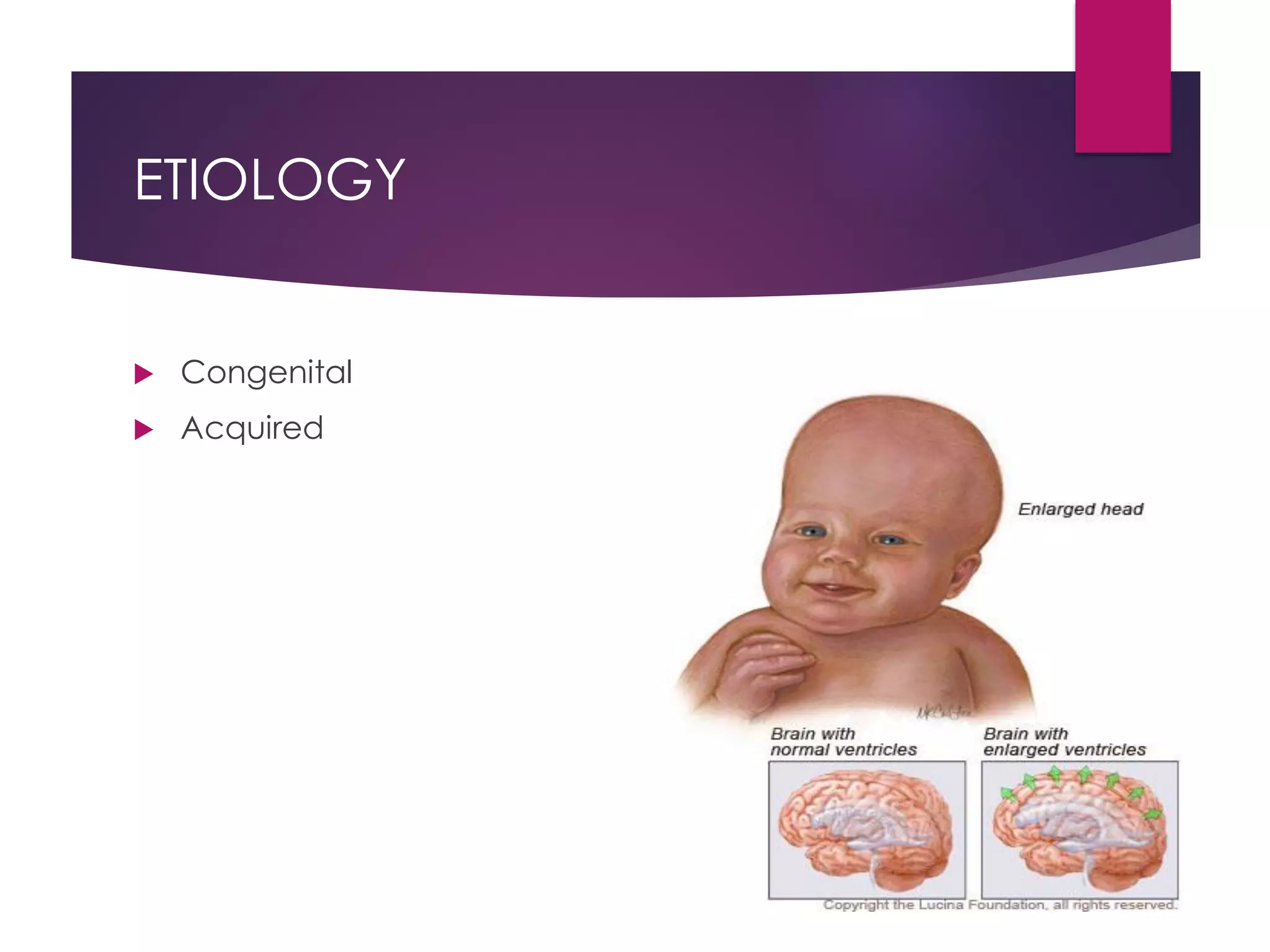 Hydrocephalus | PDF