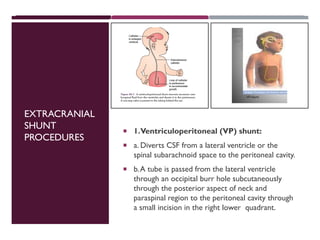 Hydrocephalus | PPT