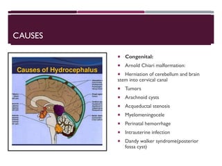 Hydrocephalus | PPT