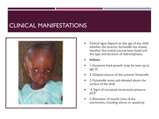 Hydrocephalus | PPT