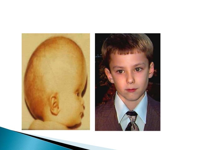 HYDROCEPHALUS | PPTX | Brain and Nervous System Disorders | Diseases ...