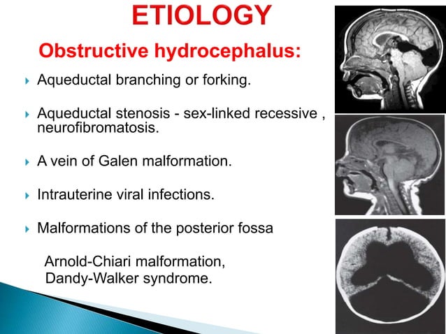 HYDROCEPHALUS | PPTX | Brain and Nervous System Disorders | Diseases ...