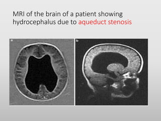Hydrocephalus in neonate