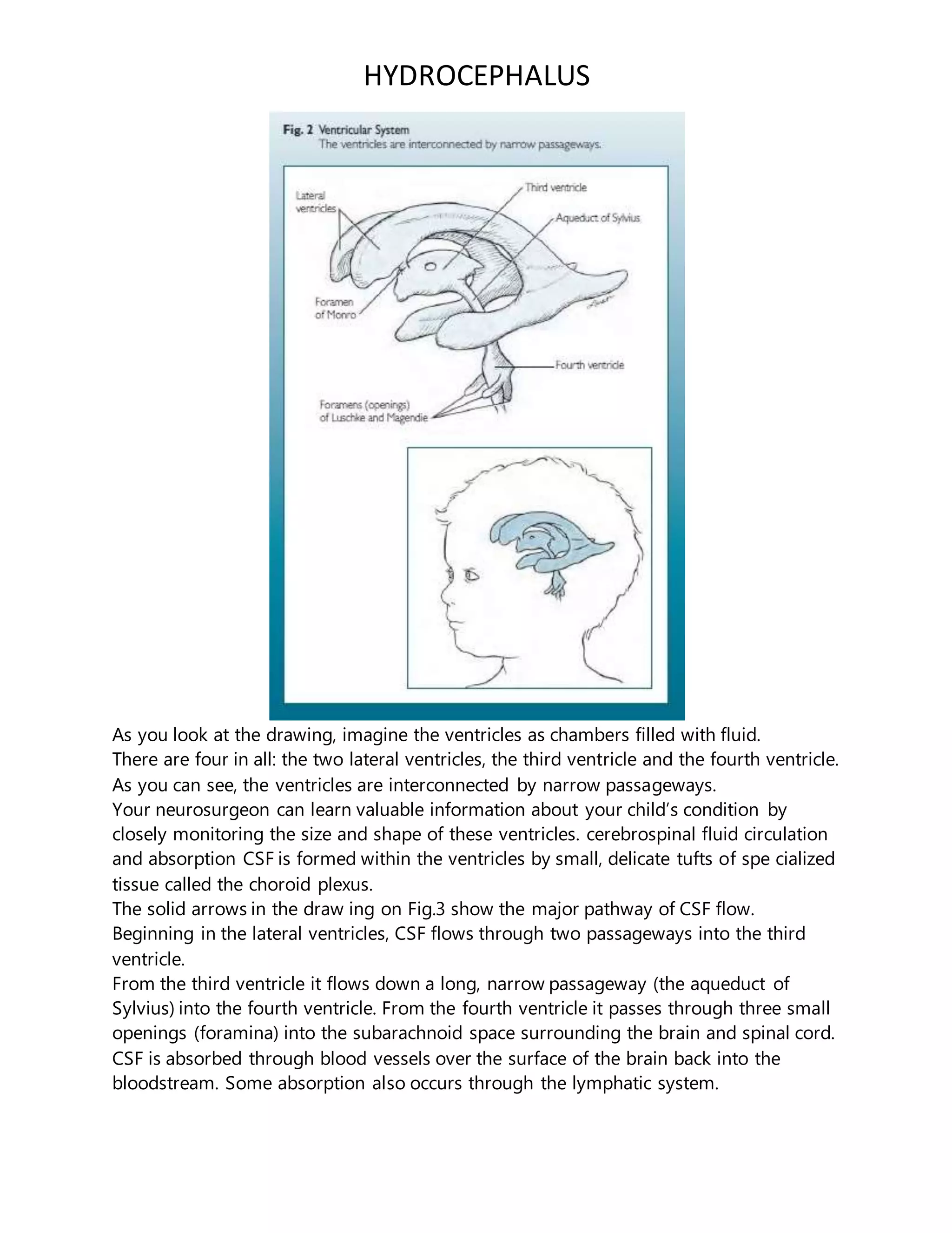 Hydrocephalus | DOCX