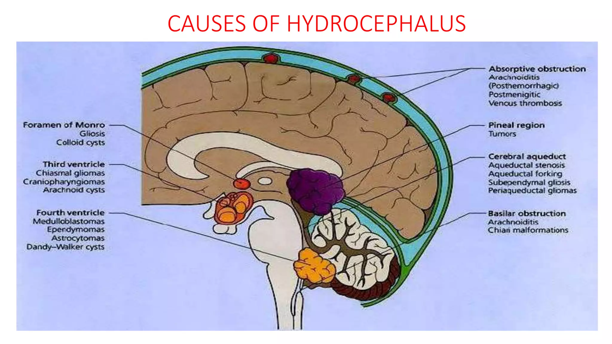 Hydrocephalus | PPTX