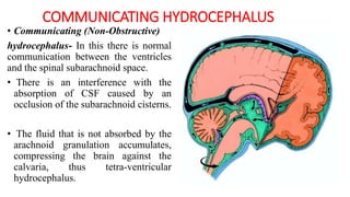 Hydrocephalus | PPTX
