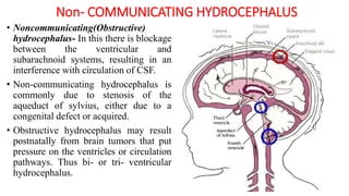Hydrocephalus | PPTX