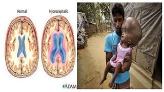 Hydrocephalus | PPTX