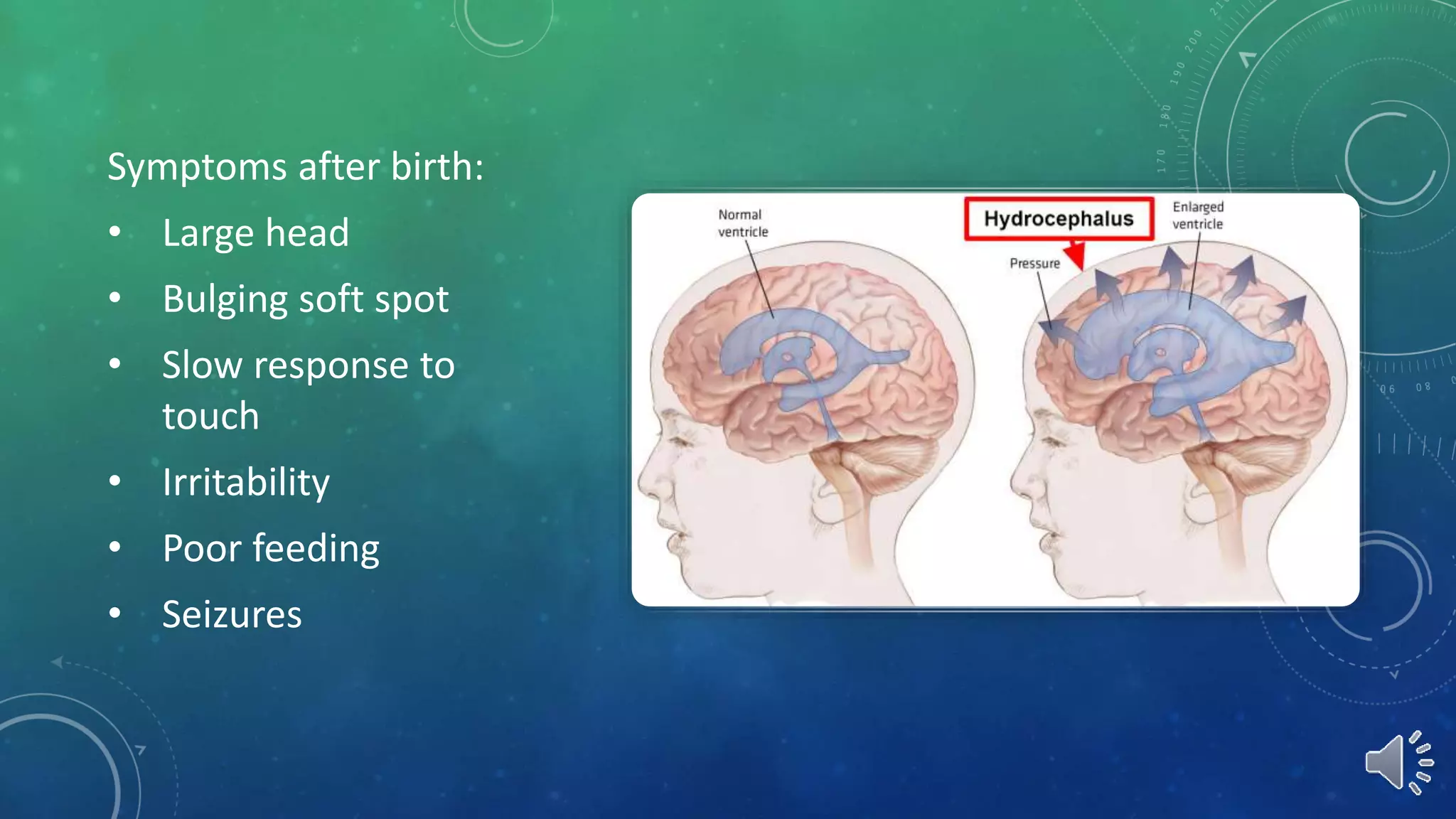 Hydrocephalus | PPTX | Pregnancy | Reproductive Health