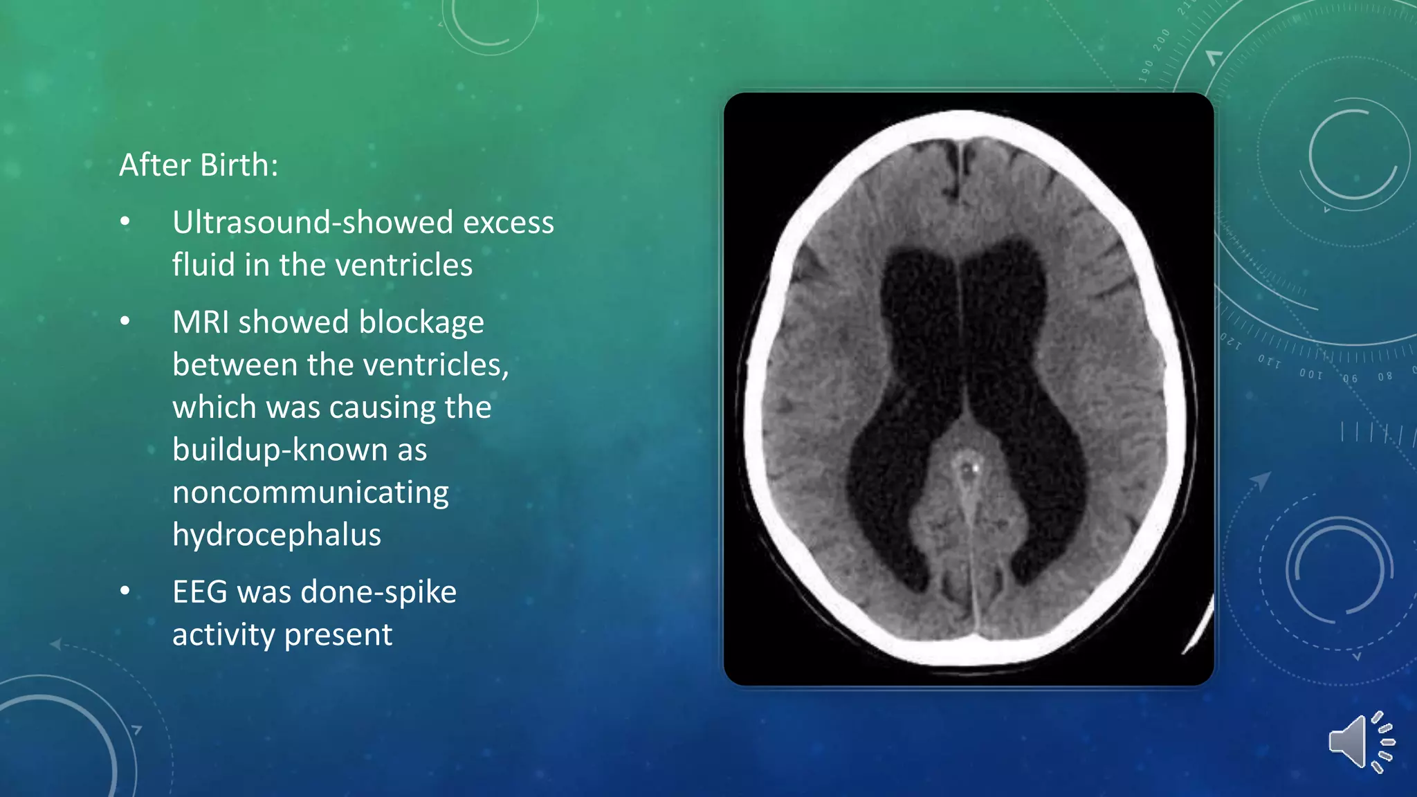 Hydrocephalus | PPTX