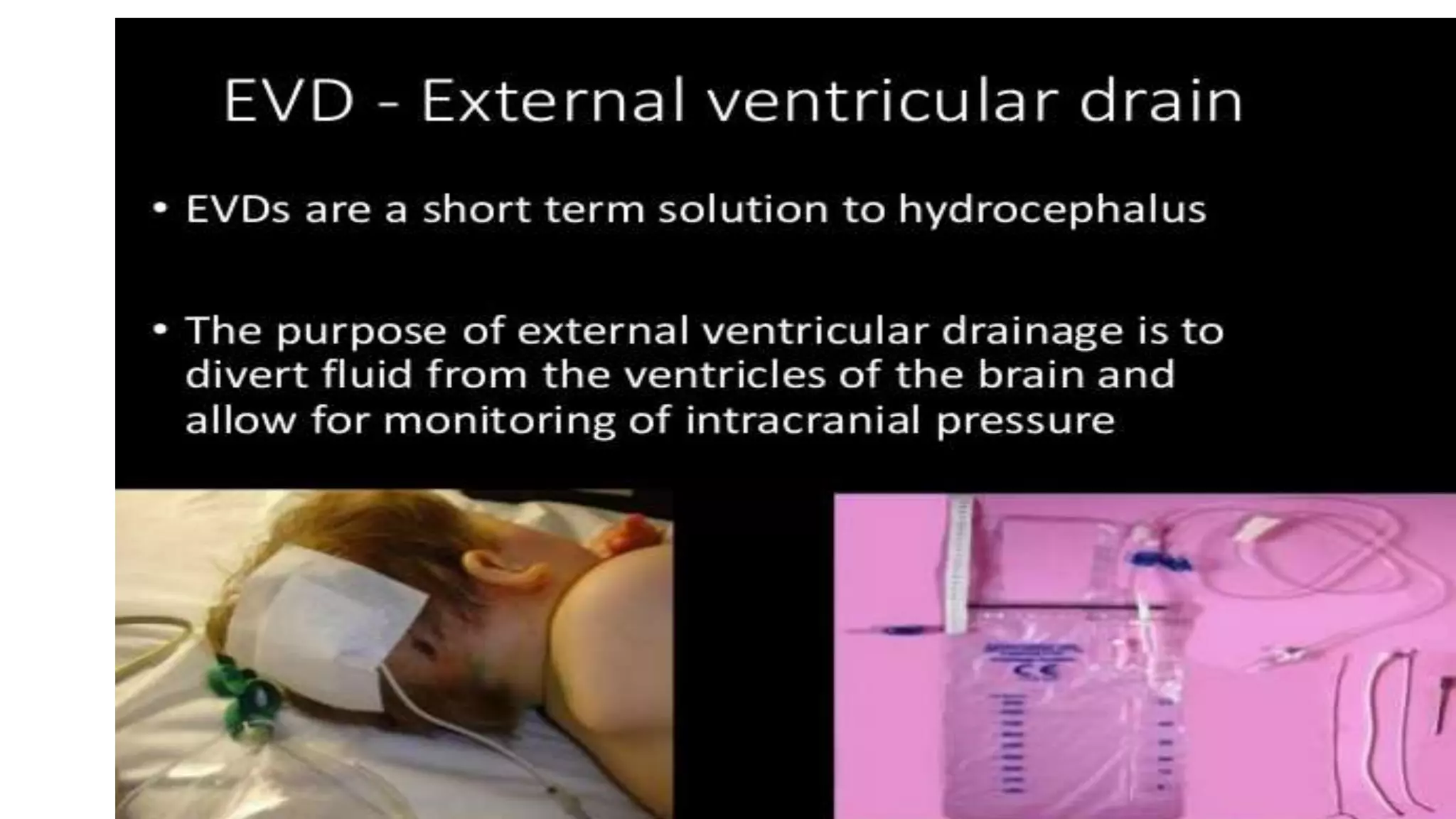 Hydrocephalus in children | PPTX