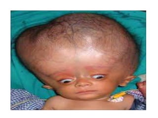 Hydrocephalus | PPT
