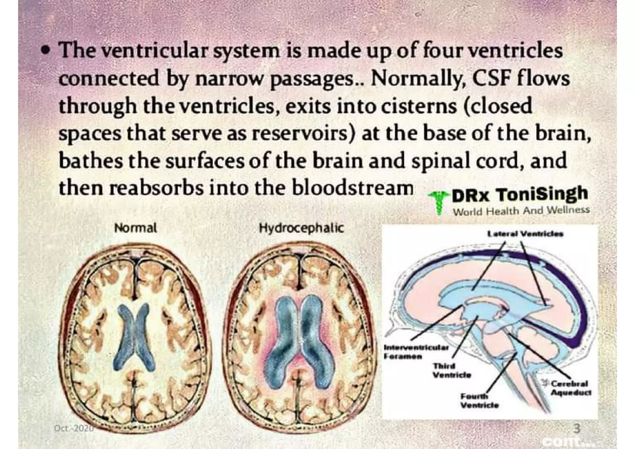 Hydrocephalus | PDF