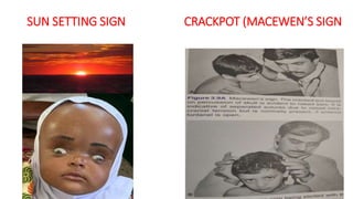 Hydrocephalus | PPTX