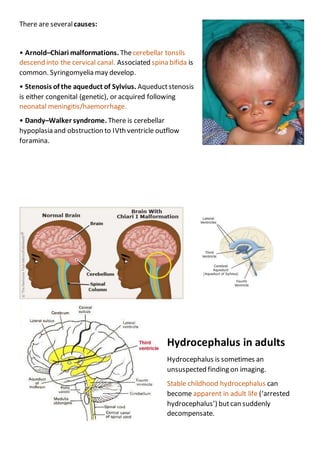How Common Is Hydrocephalus