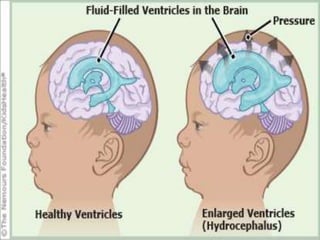 Hydrocephalus.pptx