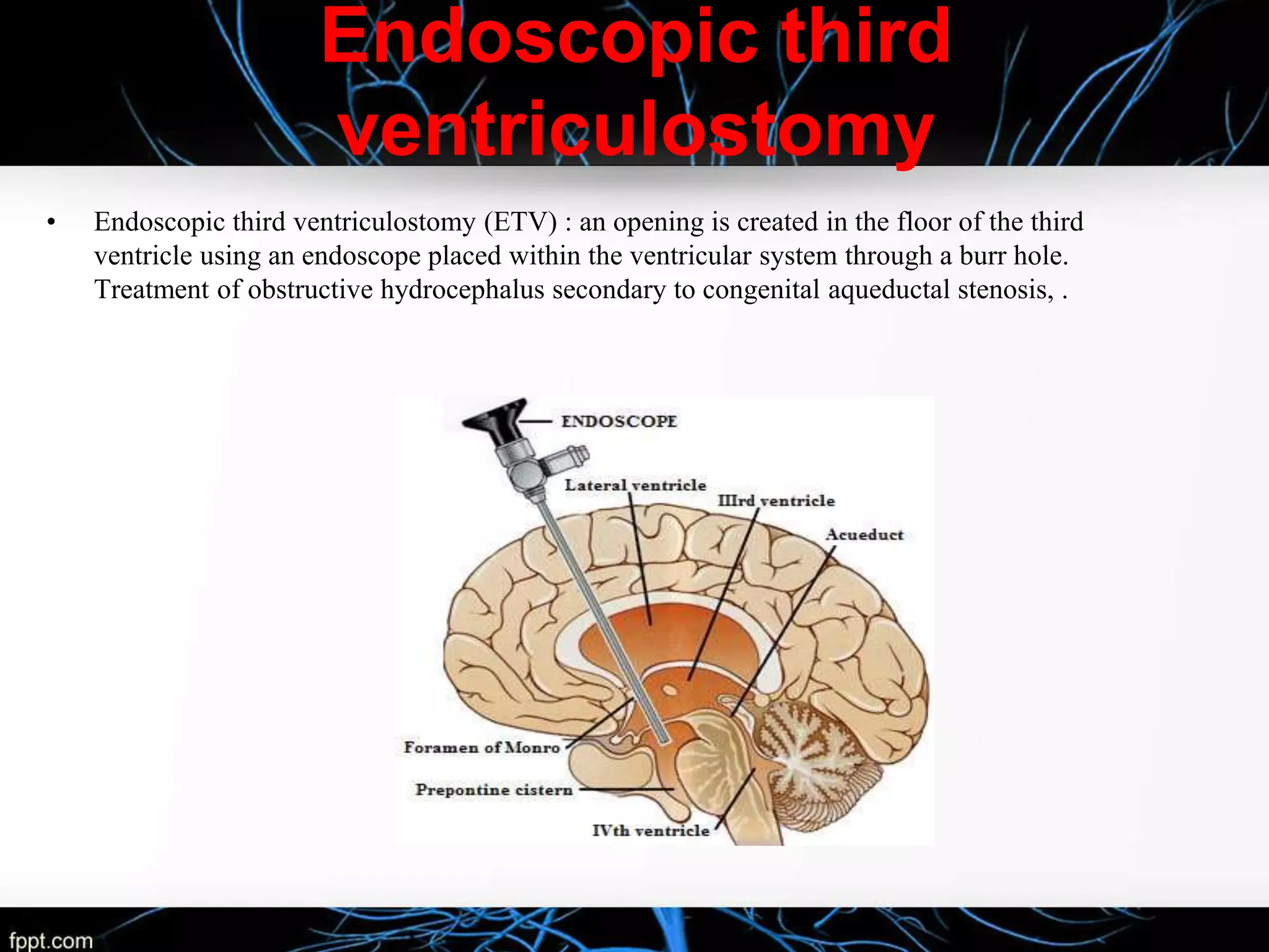 hydrocephalus.ppt | Brain and Nervous System Disorders | Diseases and ...