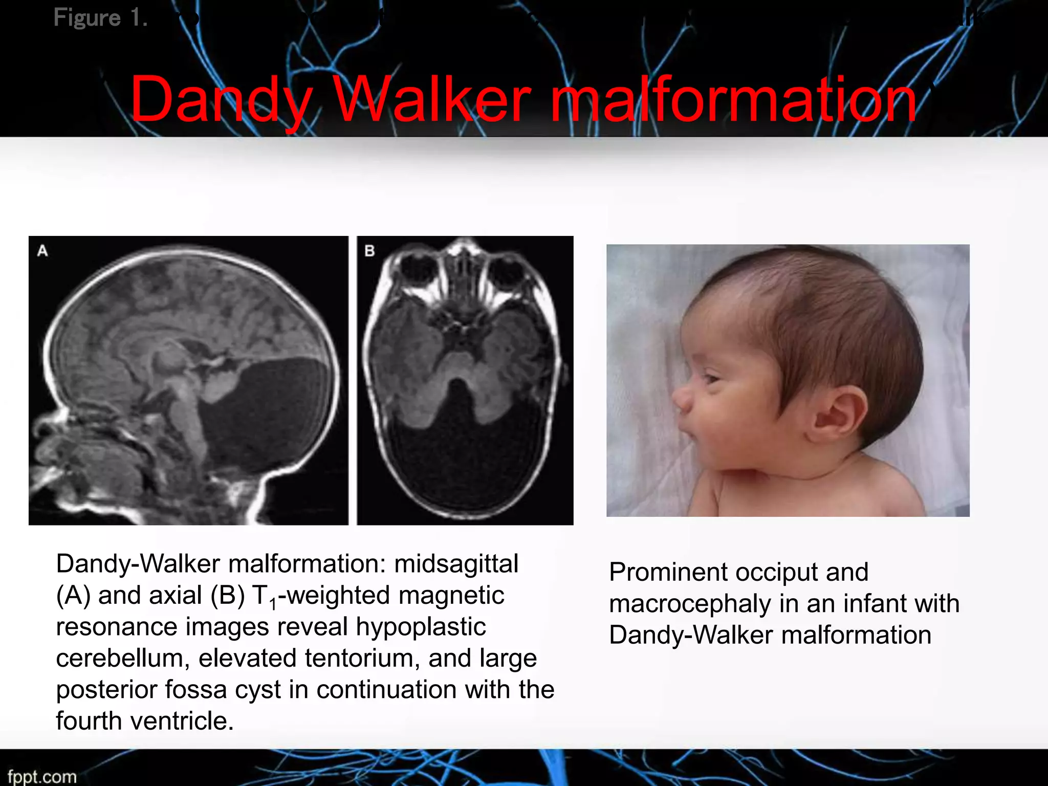 hydrocephalus.ppt | Brain and Nervous System Disorders | Diseases and ...