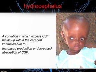 hydrocephalus.ppt