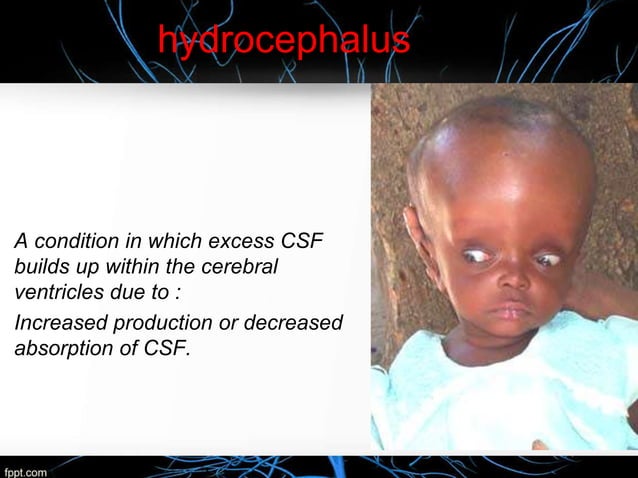 hydrocephalus.ppt | Brain and Nervous System Disorders | Diseases and ...