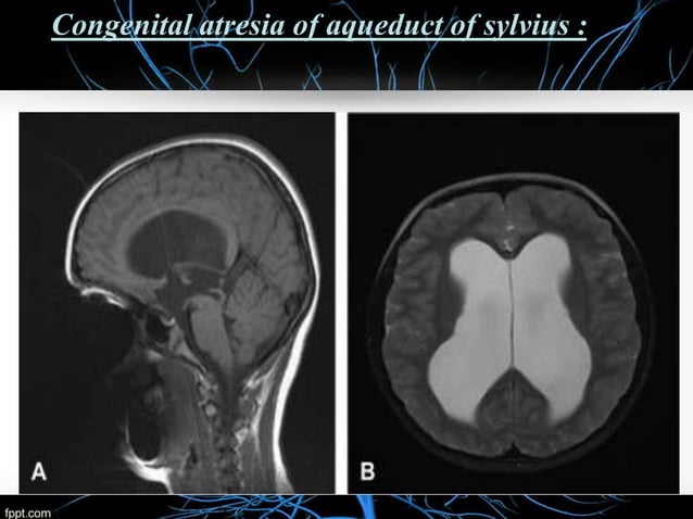 hydrocephalus.ppt | Brain and Nervous System Disorders | Diseases and ...