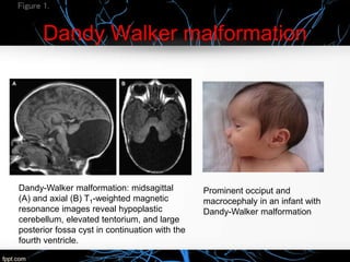hydrocephalus.ppt | Brain and Nervous System Disorders | Diseases and ...