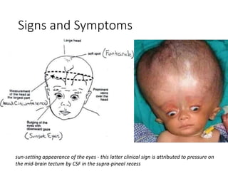 HYDROCEPHALUS.pptx