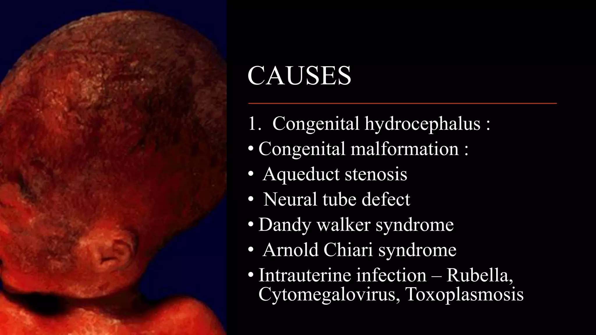 hydrocephalus.pptx