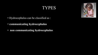 hydrocephalus.pptx