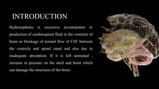 hydrocephalus.pptx