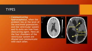 I LOVE NEUROSURGERY INITIATIVE: HYDROCEPHALUS.pptx