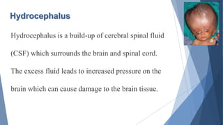 hydrocephalus.pptx