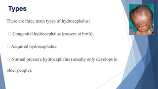 hydrocephalus.pptx