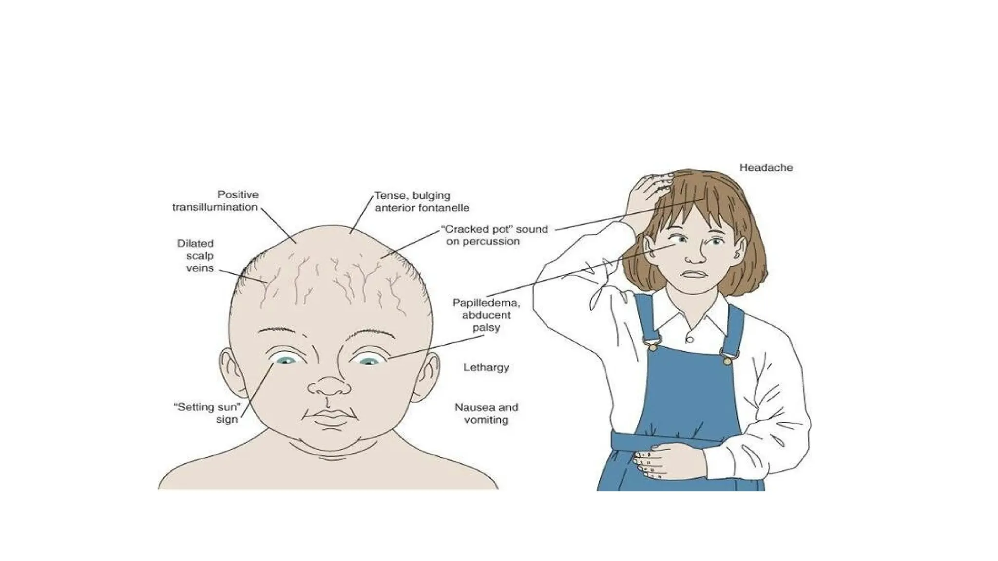 Hydrocephalus symptoms and treatment ppt | PPTX