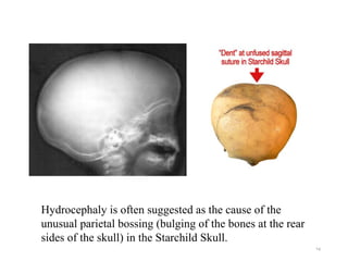 Hydrocephalus in children population.pptx