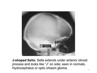 Hydrocephalus in children population.pptx