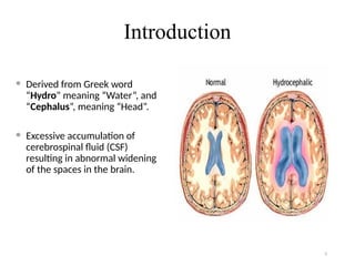 Hydrocephalus in children population.pptx