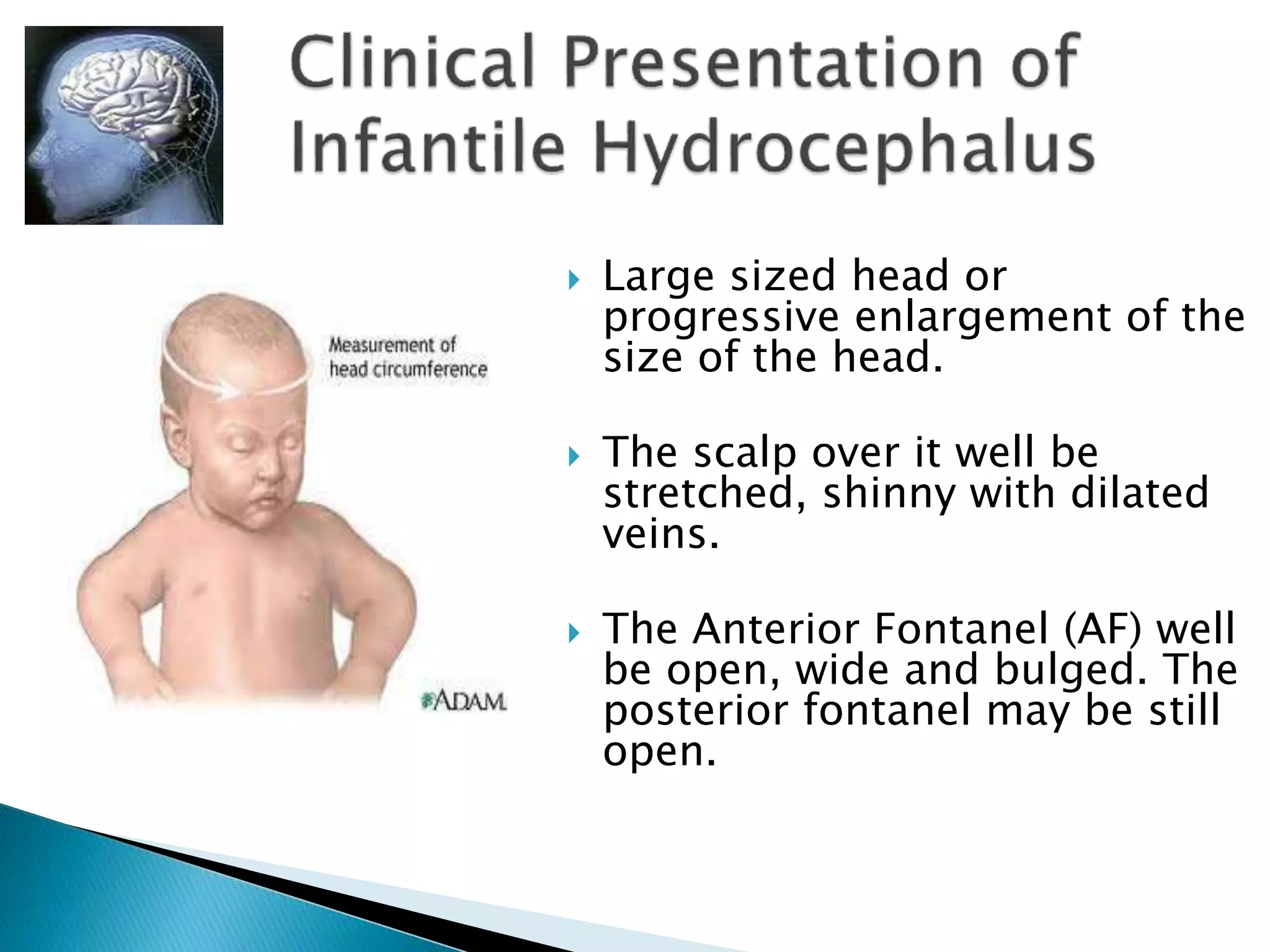 Hydrocephalus - Case Presentation (2).ppt