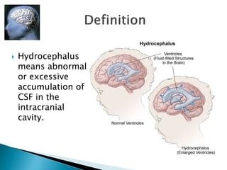Hydrocephalus - Case Presentation (2).ppt