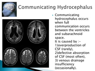 Hydrocephalus - Case Presentation (2).ppt