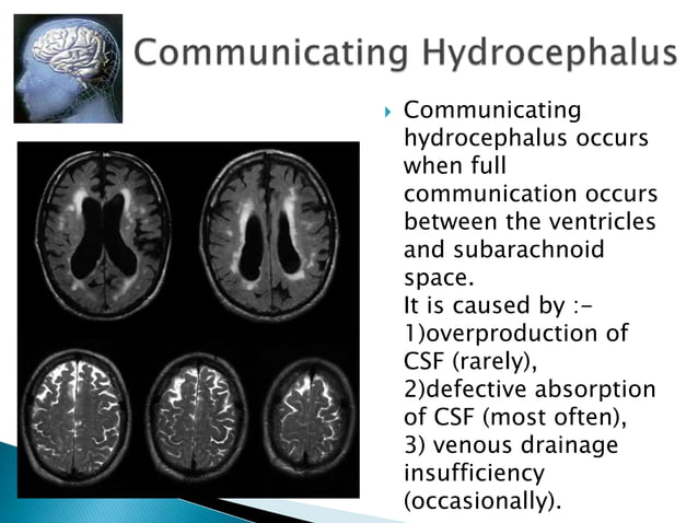 Hydrocephalus - Case Presentation (2).ppt | Brain and Nervous System ...