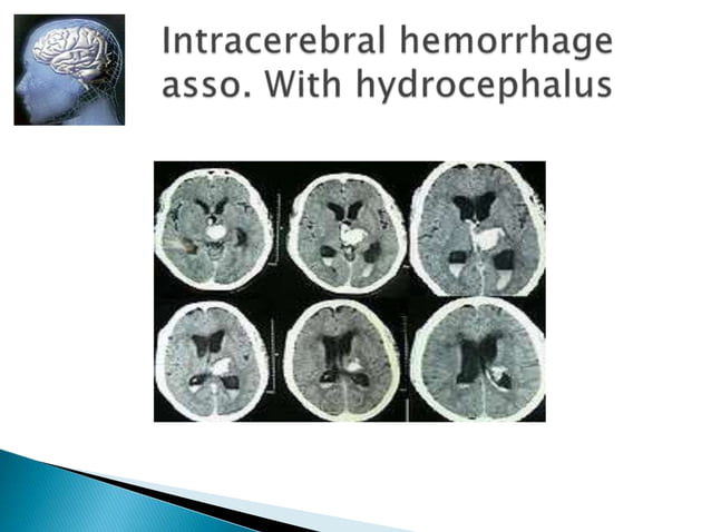 Hydrocephalus - Case Presentation (2).ppt | Brain and Nervous System ...