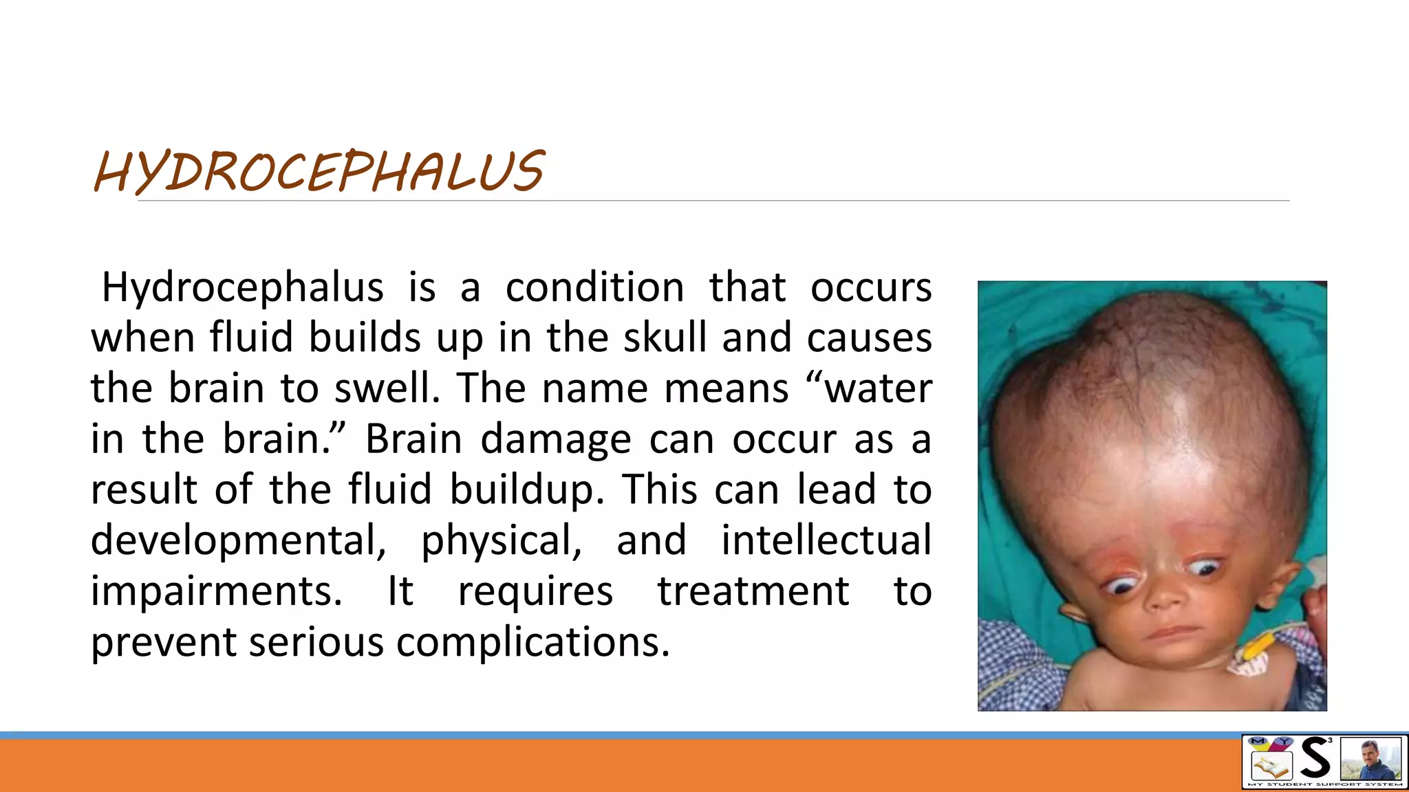 Hydrocephalus english | PPTX