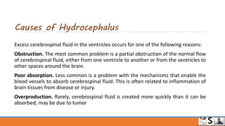 Hydrocephalus english | PPTX