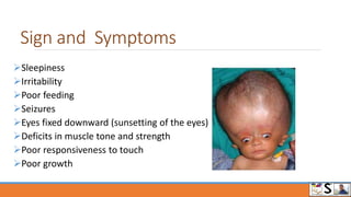Hydrocephalus english | PPTX