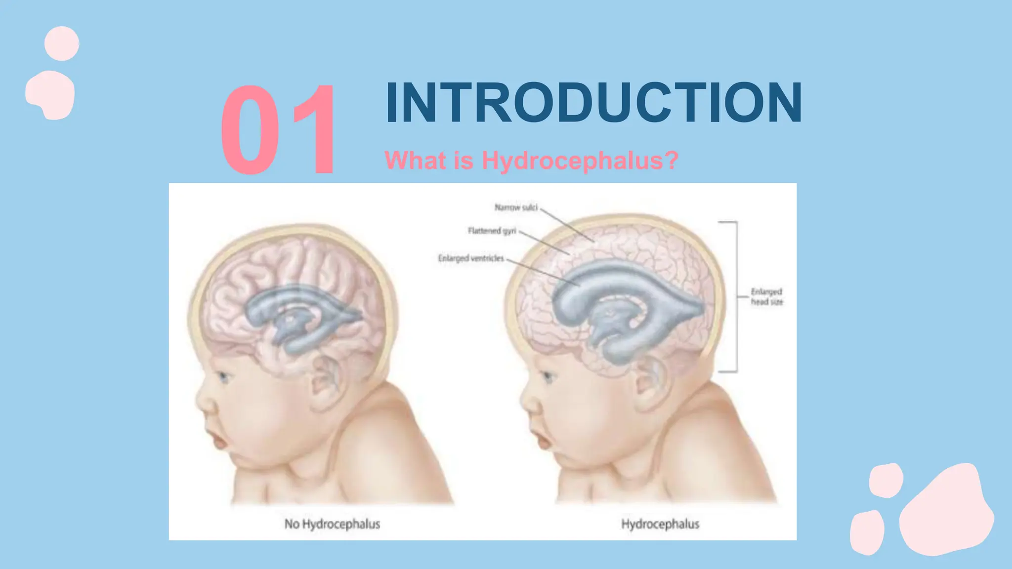 Hydrocephalus in neonates -Marwa Chehadeh.pptx