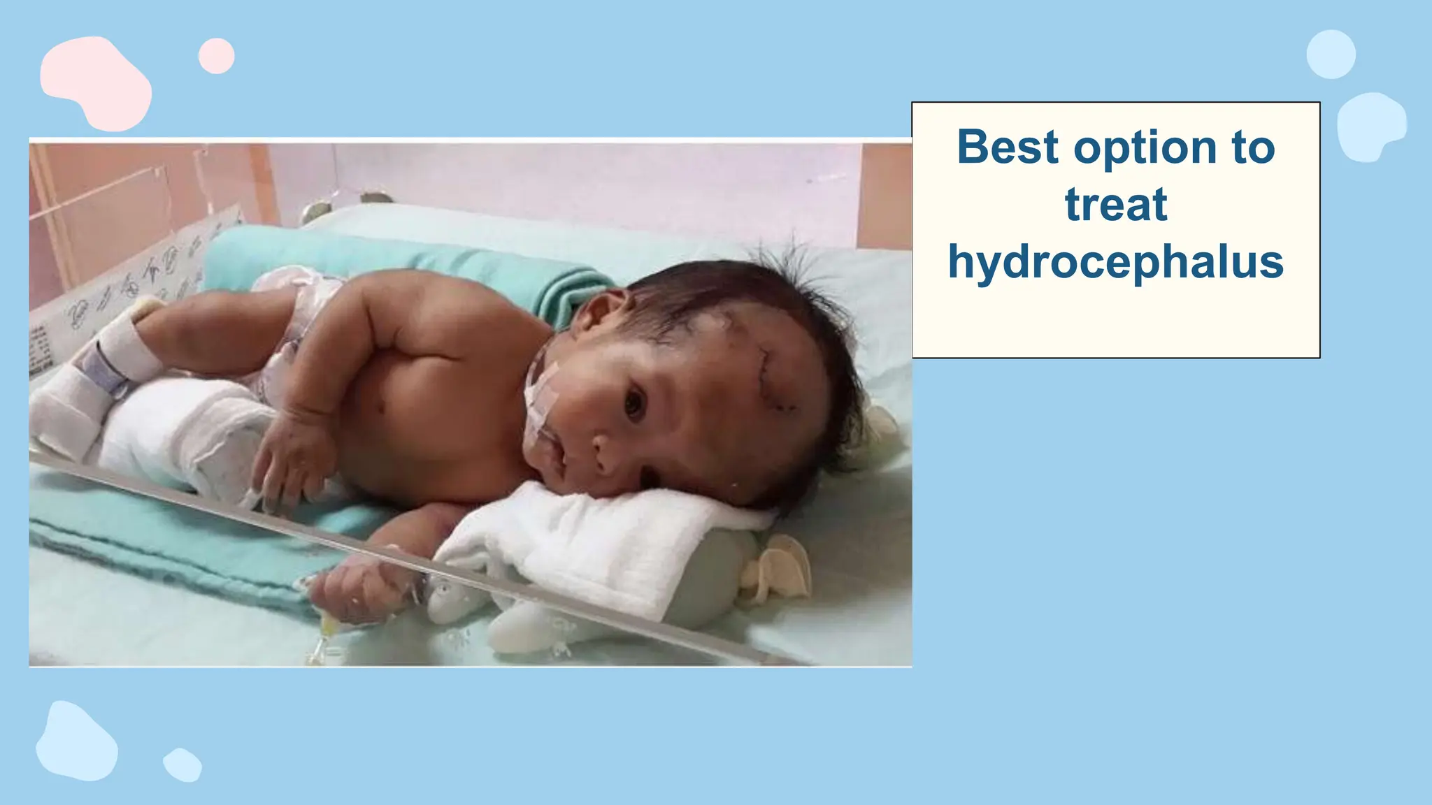 Hydrocephalus in neonates -Marwa Chehadeh.pptx