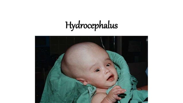 Hydrocephalus | PPTX | Brain and Nervous System Disorders | Diseases ...